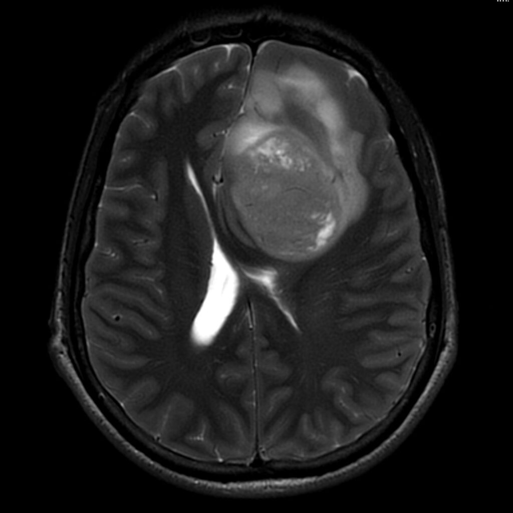 Application Of Machine Learning And Deep Learning In Brain Tumor